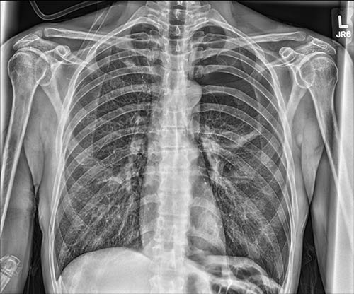 Visualizzazione dello pneumotorace