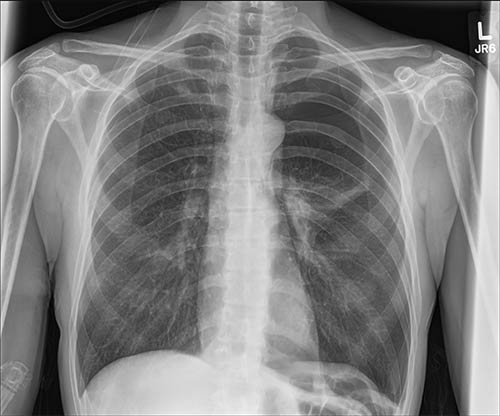Visualizzazione dello pneumotorace